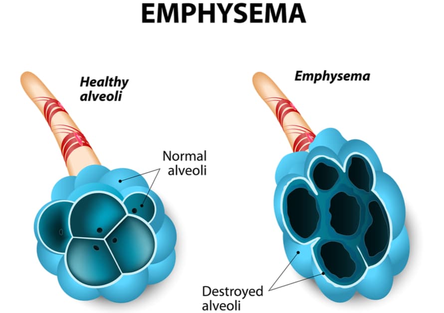 What Is Emphysema and What Causes It? - SCALAR LIGHT